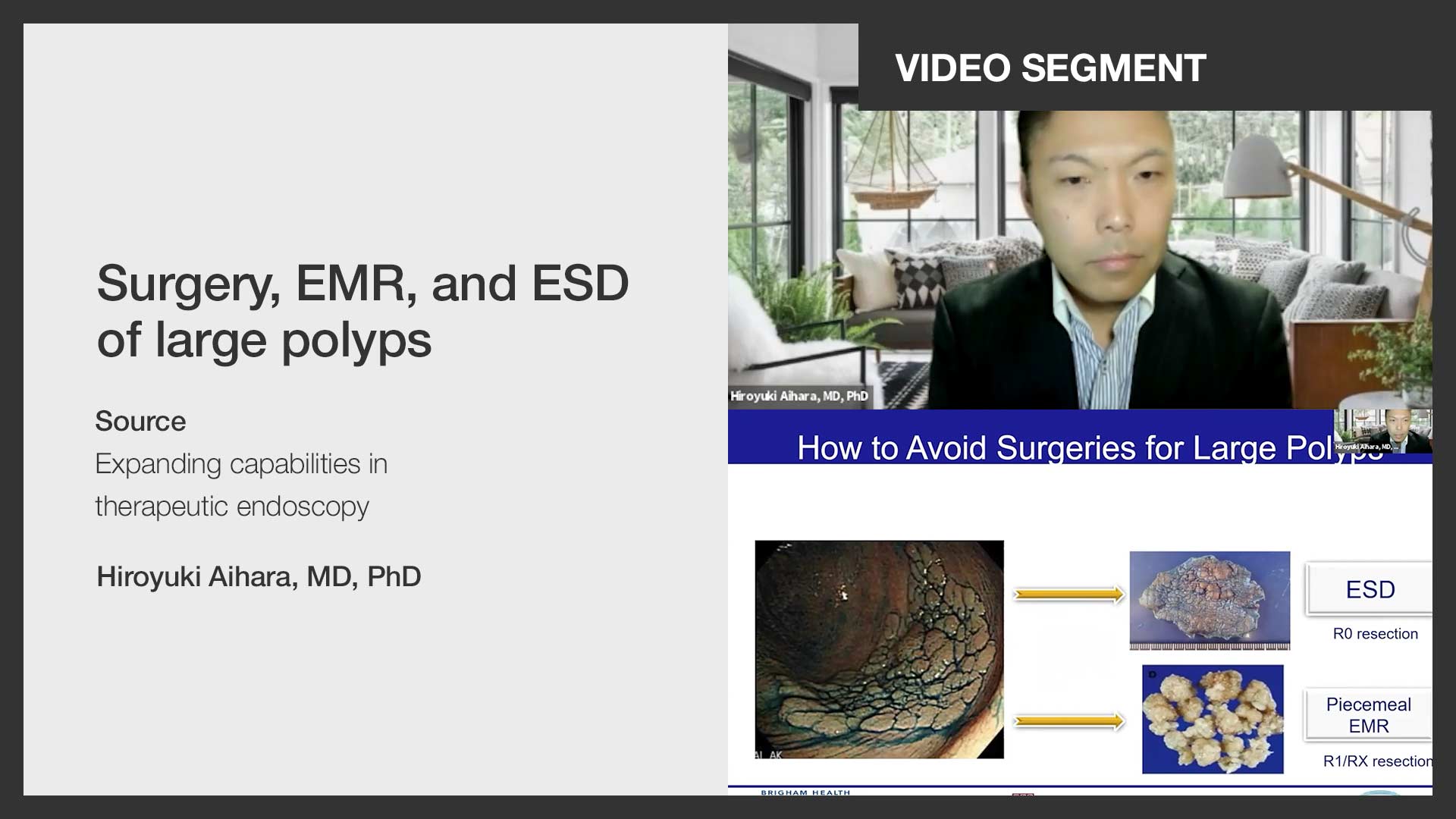 Surgery, EMR, and ESD of large polyps - Clinical Learning and ...