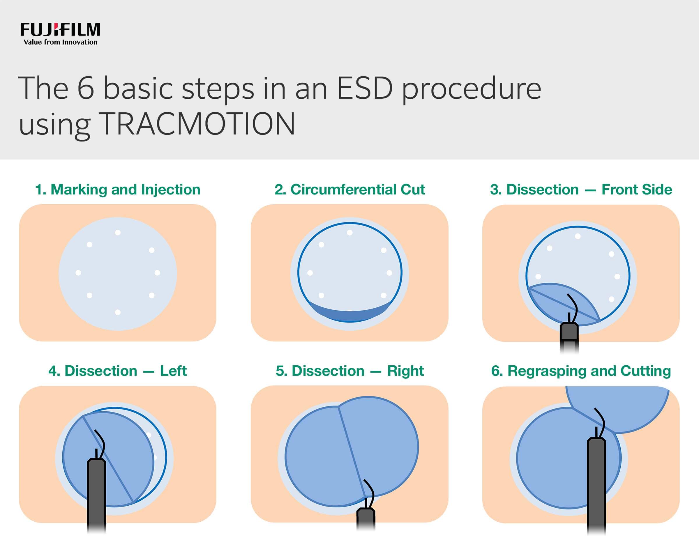 ESD Endoscopic Submucosal Dissection - Clinical Learning and Innovation ...